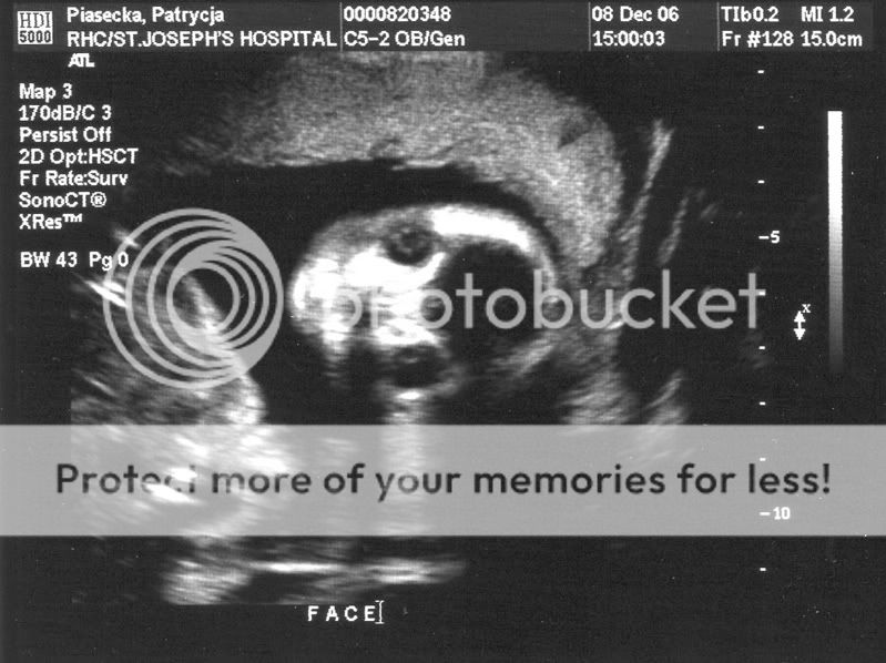 Medical Ultrasound | Reference Ranges Of Amniotic Fluid Index In Late ...